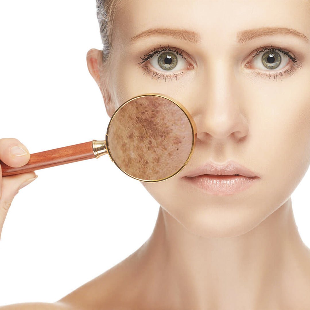 Unveiling the Secrets of Hyperpigmentation by Skin Chemistry: Causes a